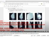 Mammogram Classification Using Deep Learning Cnn Python Code
